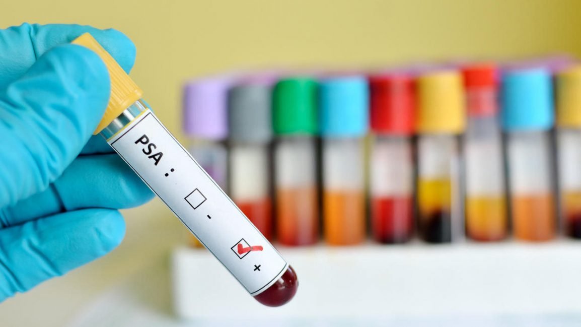 IMPORTANCE DE LA PHASE PRE-ANALYTIQUE – Biologica